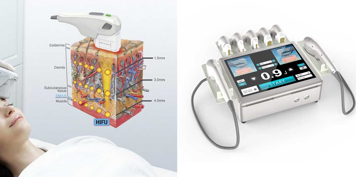 What Are The Benefits of HIFU Facial Machines? - Adelyn Cline